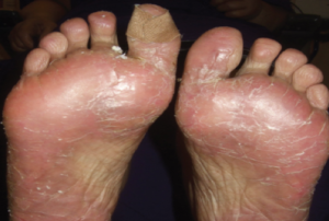 How Does Cancer Treatment Affect The Feet? - Physio & Sole Clinic