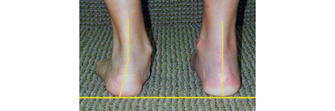 3 Common Foot Problems Teachers Face - Physio & Sole Clinic
