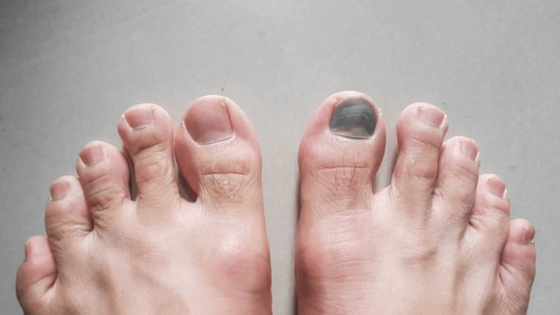 Bruised Nail | Causes, Symptoms & Treatment in Singapore