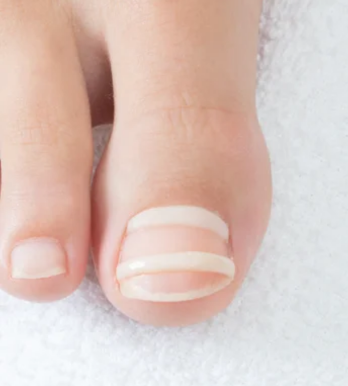 NAIL BRACING 趾甲支架 - Physio & Sole Clinic