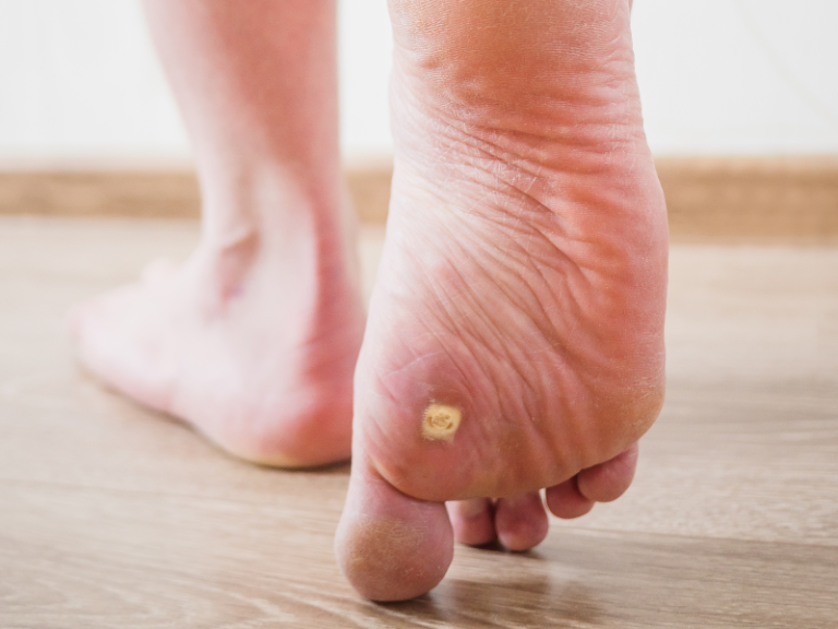 Corns and Warts | Expert Treatment & Foot Care in Singapore