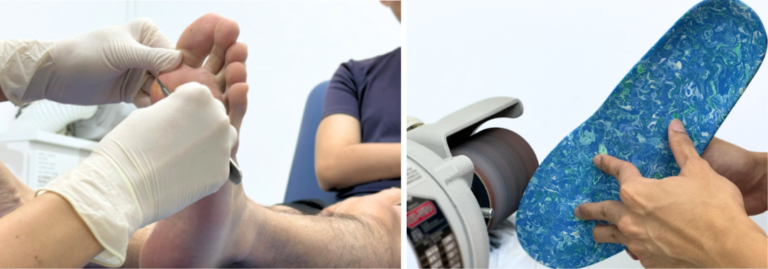 Corn and Callus Treatment: Home vs. Professional Removal