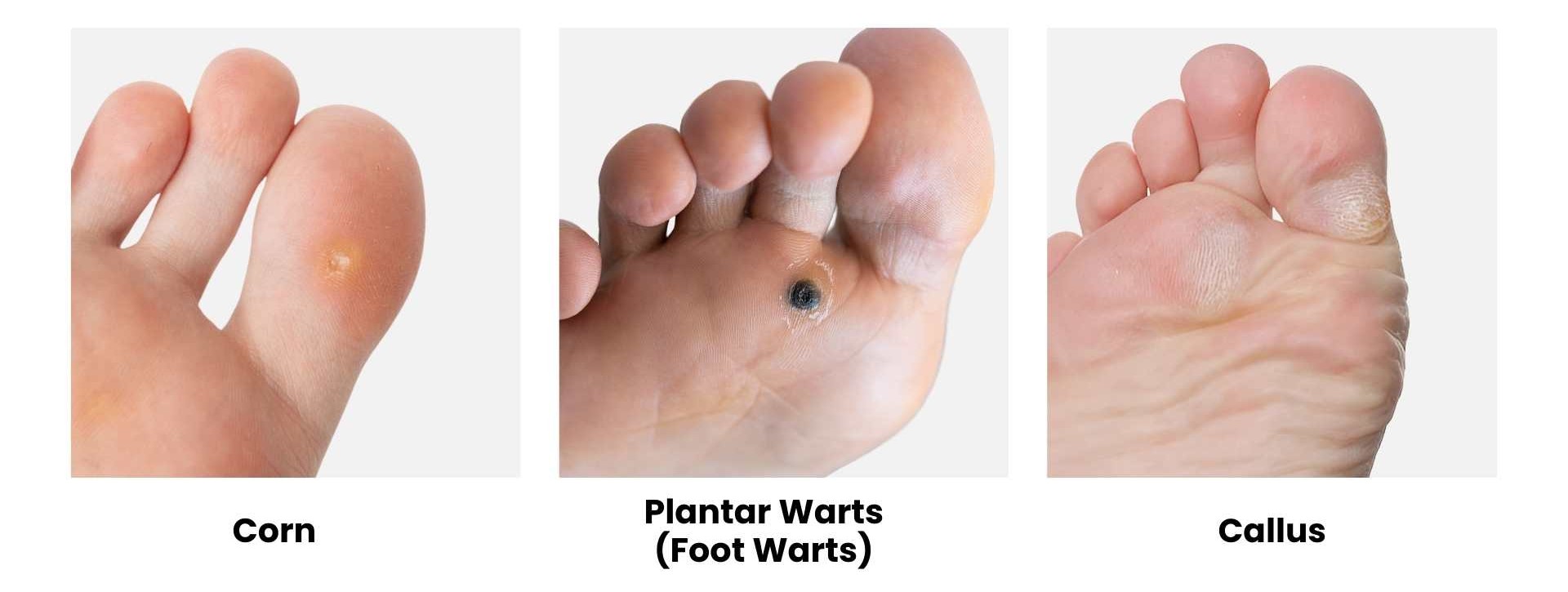 Plantar Warts | Causes, Symptoms & How to Get Rid of Them