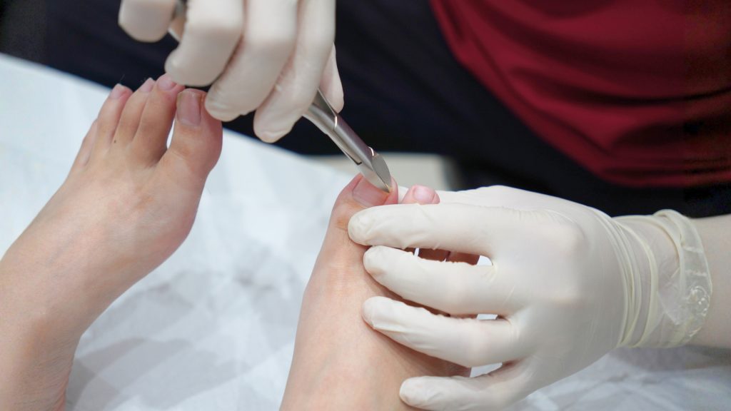 Nail Fungus Treatment | Best Toenail Fungus Treatment Singapore